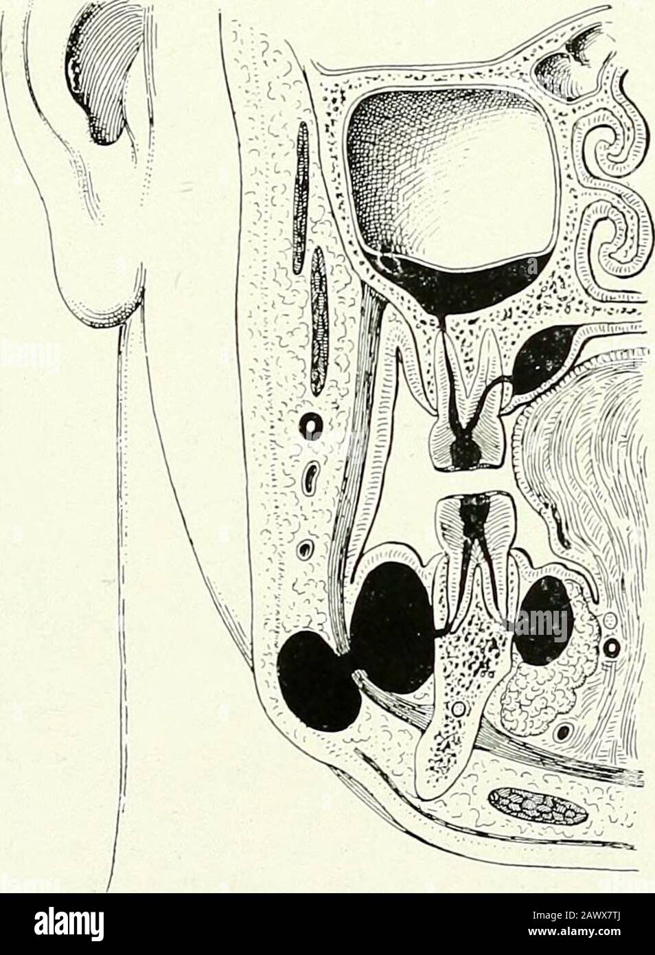 Surgical therapeutics and operative technique . Fig. 119.—-Caries of an ...