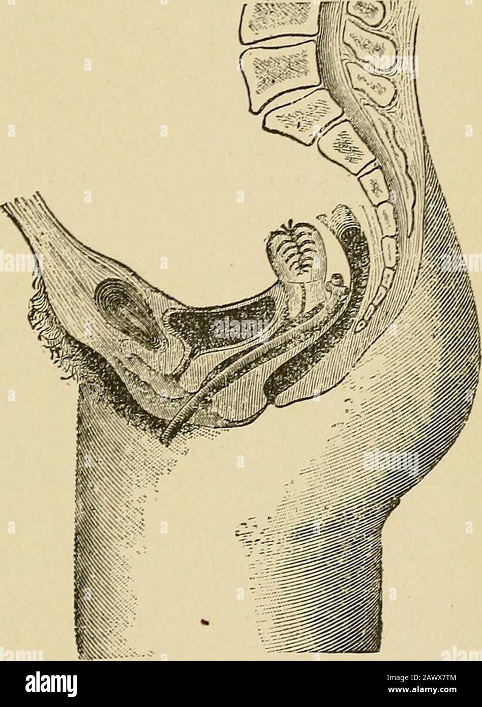 Cauterize hi-res stock photography and images - Alamy