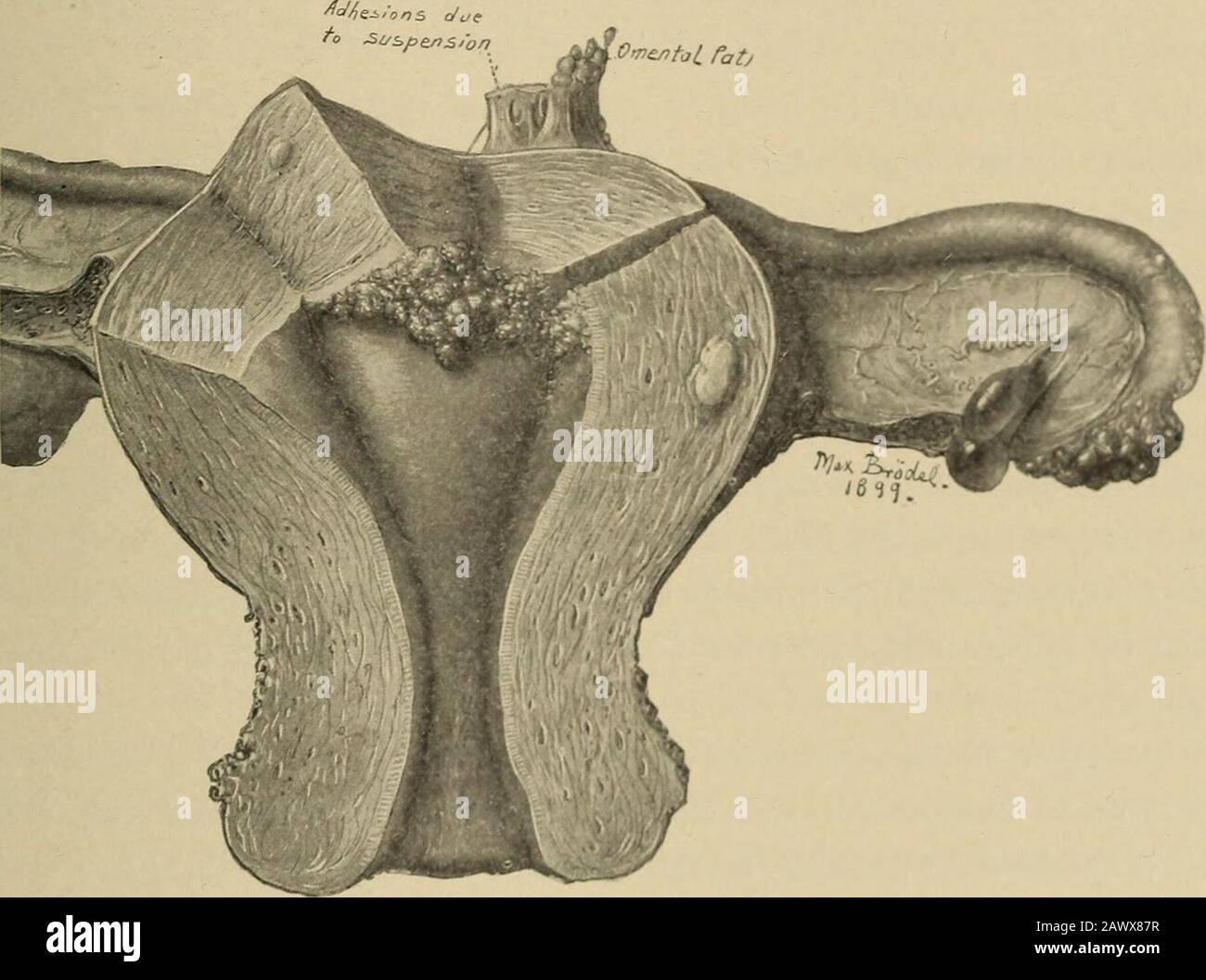 Necrosis uterus hi-res stock photography and images - Alamy