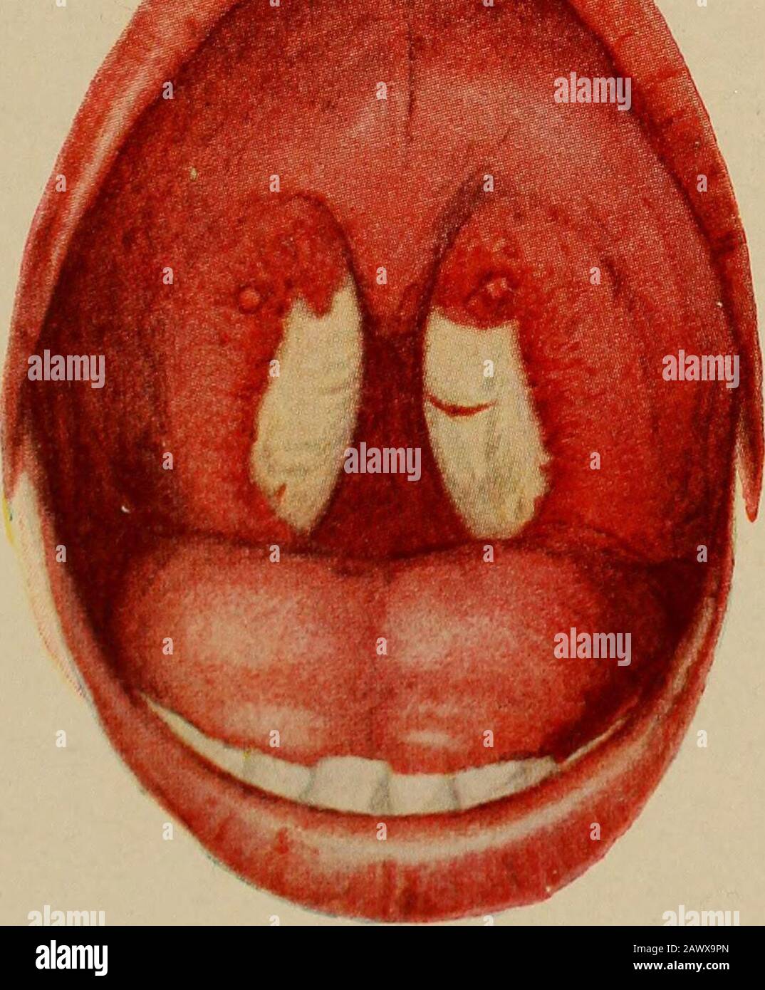 Diseases of children for nurses . Diphtheria of the lips (Hecker ...