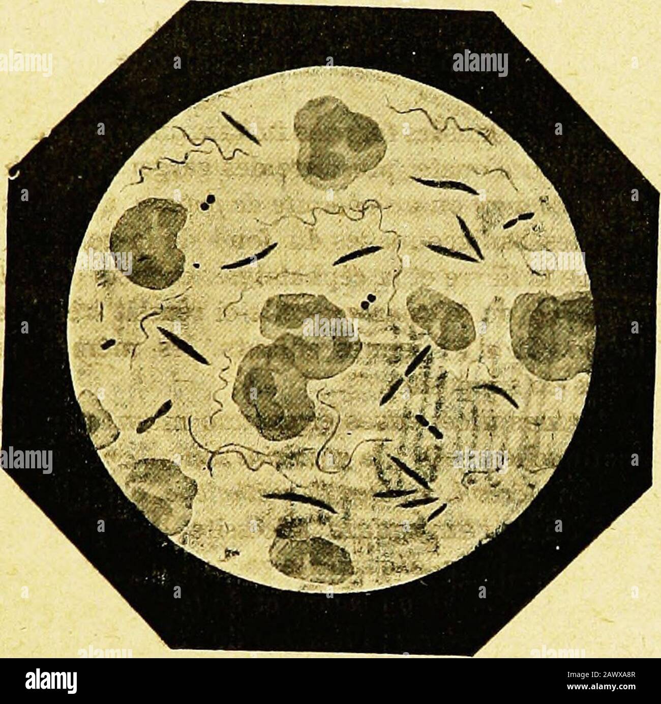 Phlegmon hi-res stock photography and images - Alamy