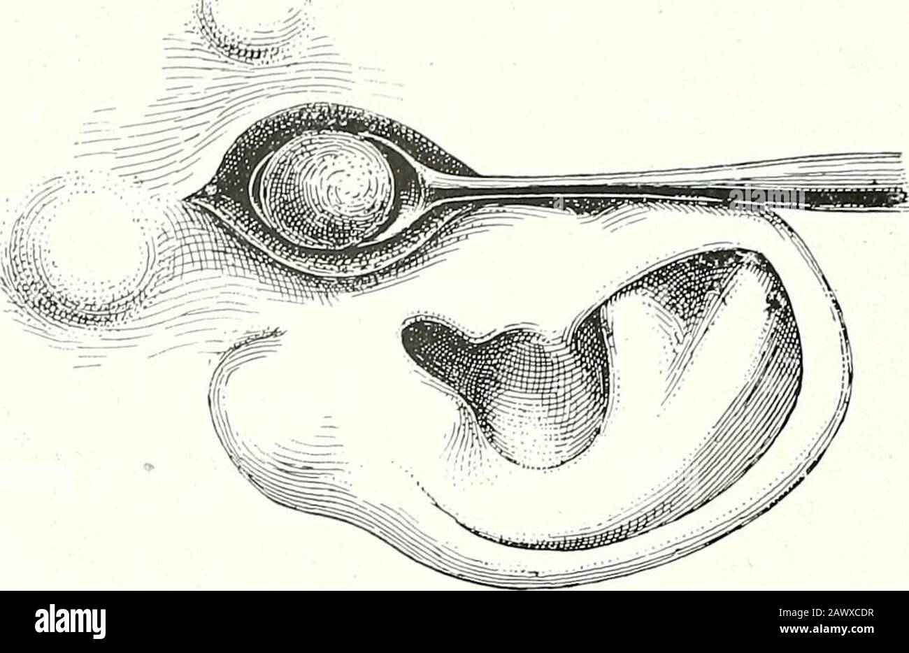 Surgical therapeutics and operative technique . Fig. 109.-—Horizontal ...