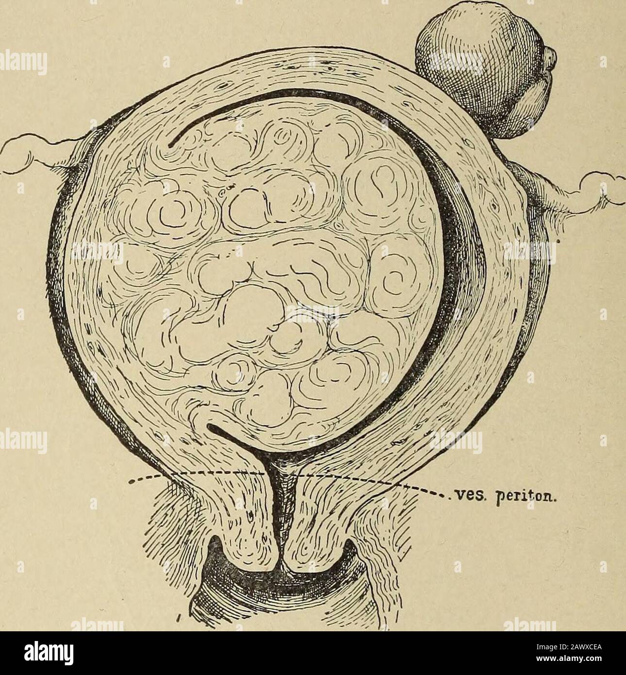 Gynecological diagnosis . .—Diagram Showing an Intraligamentous Fibroid ...