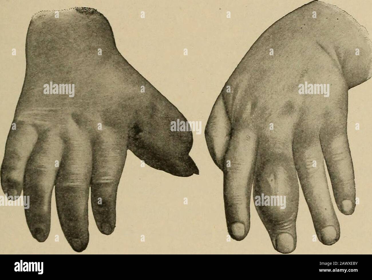 Diseases of children for nurses . the abdomen, it is rotated inward,the ...