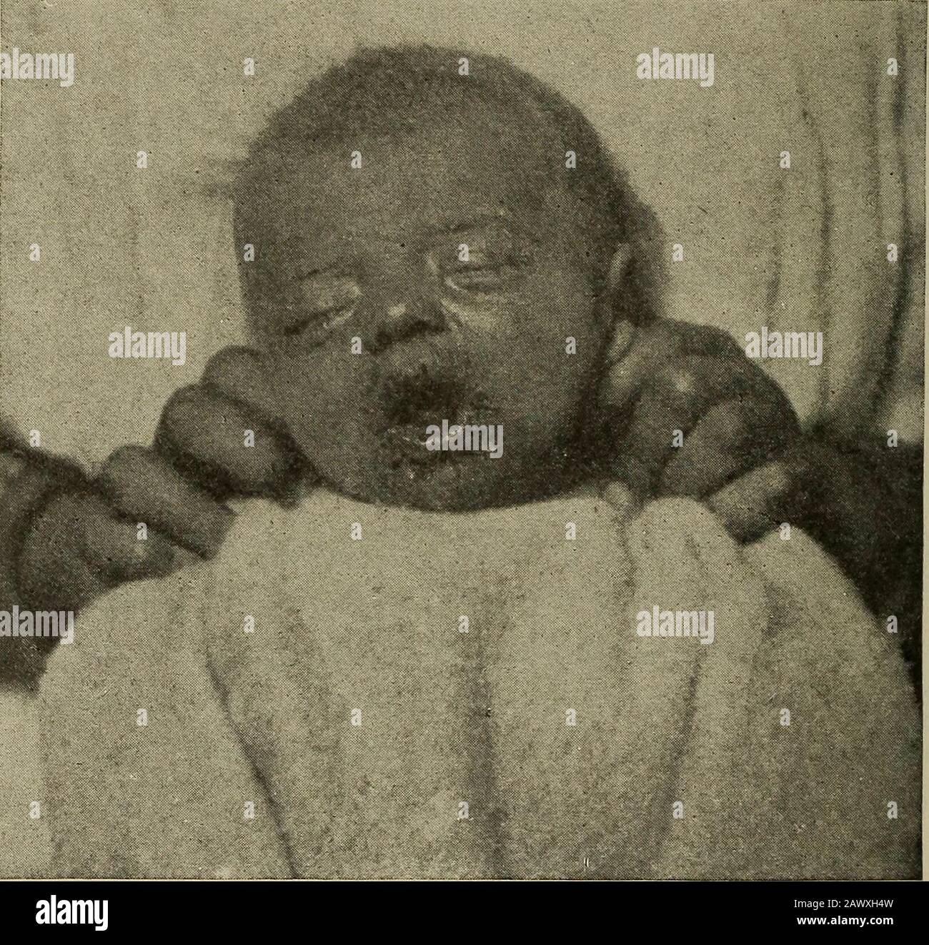 Diseases of children for nurses . s in all stages, but especially inthe ...