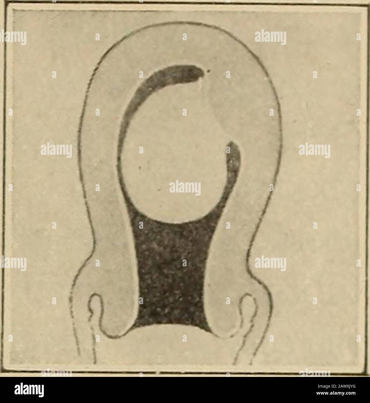Gynecological diagnosis . Fig. 95—PedunculatedSubmucous Fibroid Sim ...
