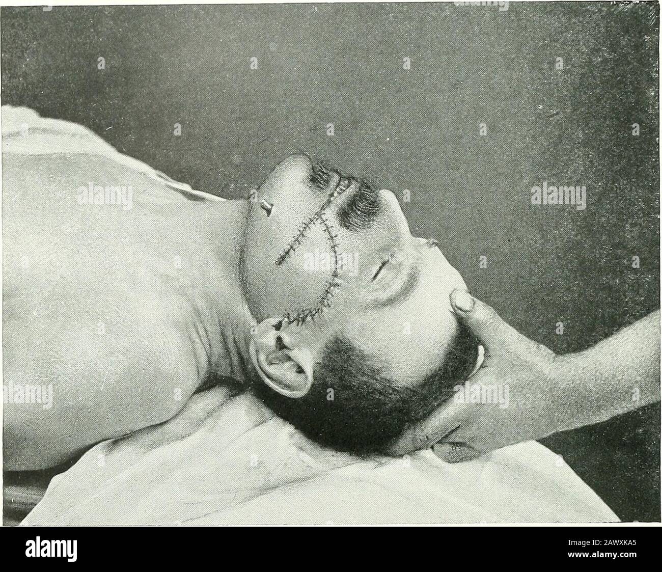 Surgical therapeutics and operative technique . Fig. 101.—Wound formed ...