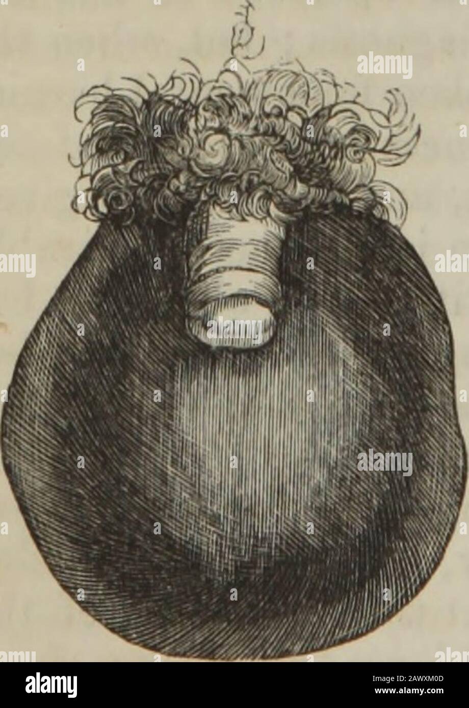 Hydrocele hi-res stock photography and images - Alamy