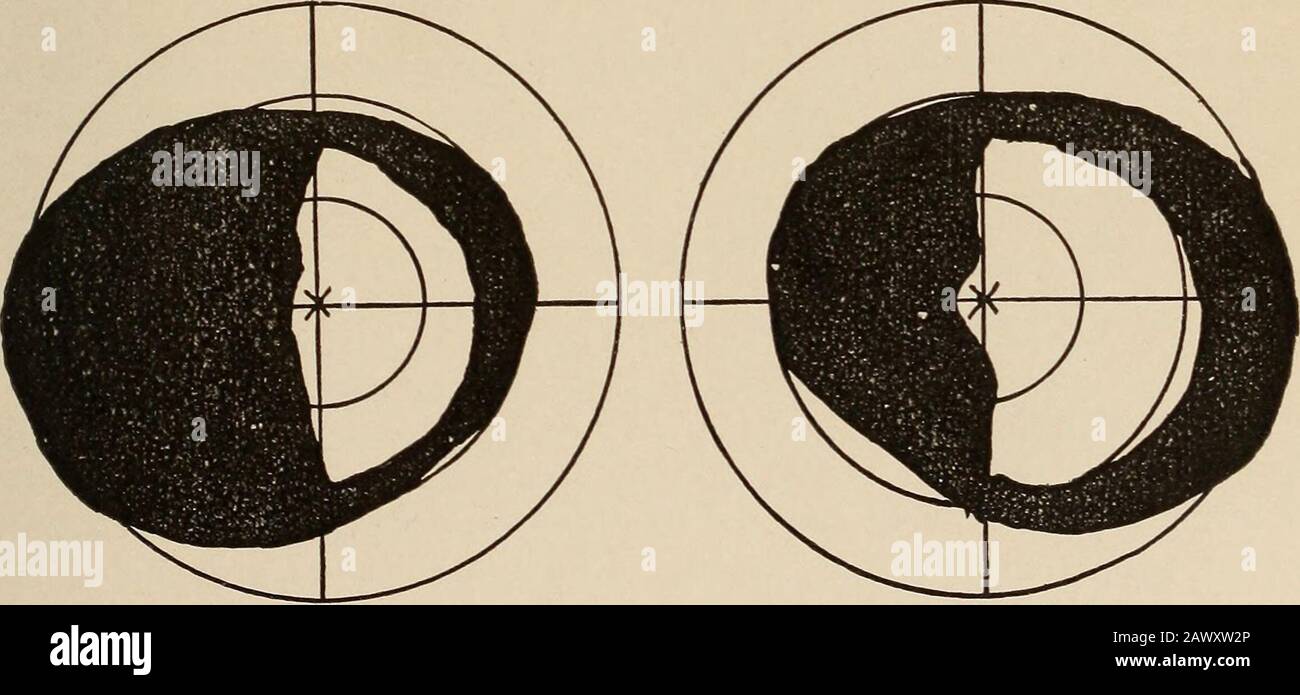 Nervous and mental diseases . Left. Right, Fig. 30.—Blindness in both ...
