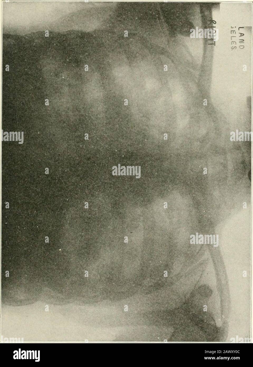 Lung tissue tuberculosis hi-res stock photography and images - Alamy