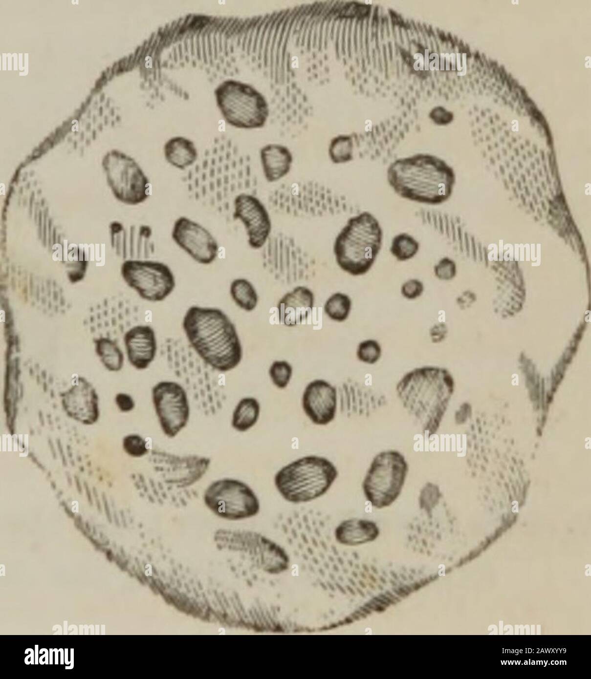 Prostatic concretion hi-res stock photography and images - Alamy