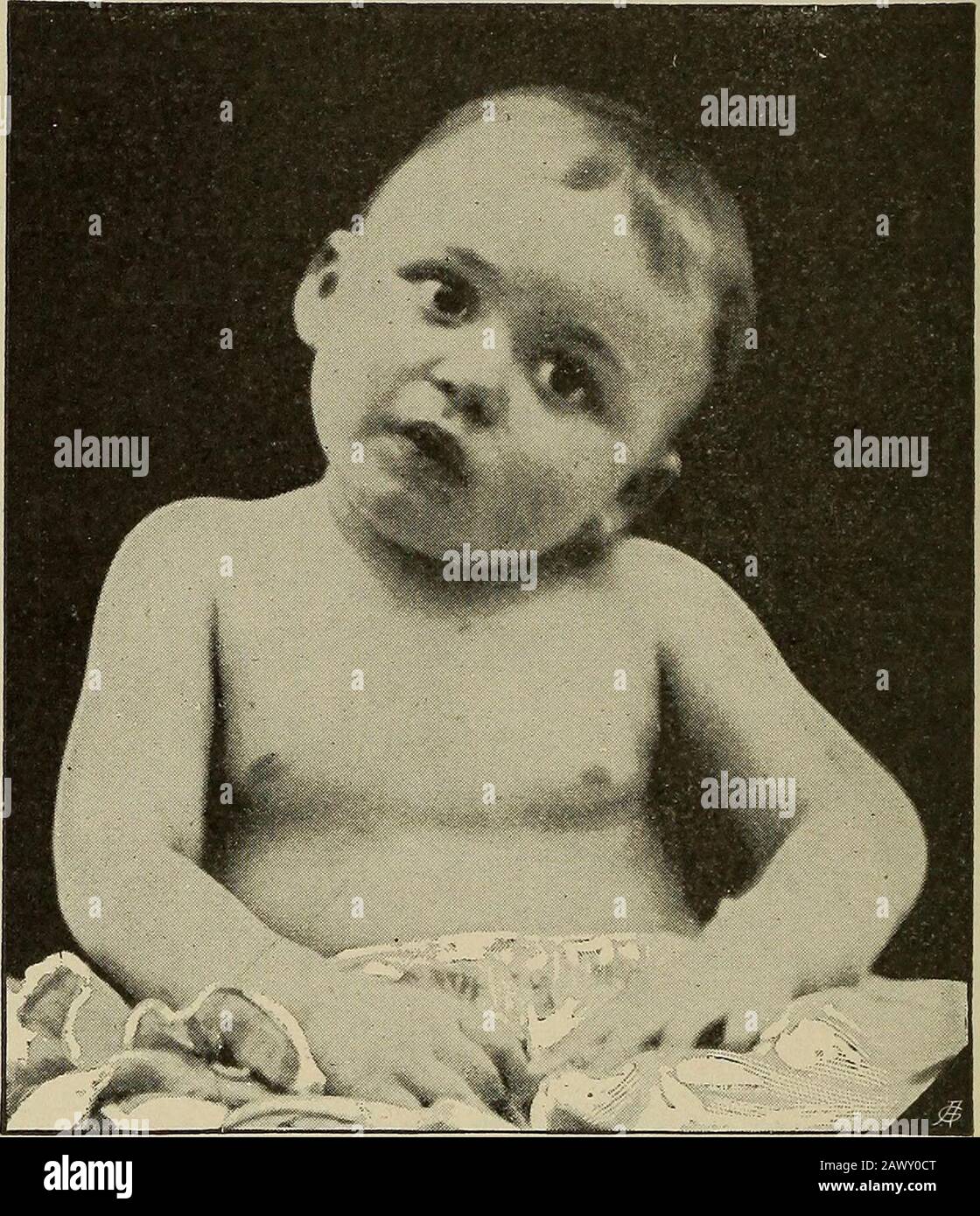 Diseases of children for nurses . lly associated with laryngismus strid ...