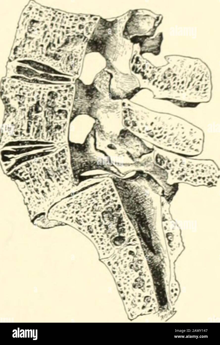 A textbook of obstetrics . Fig. 325.—Spondylolisthesis, well marked ...