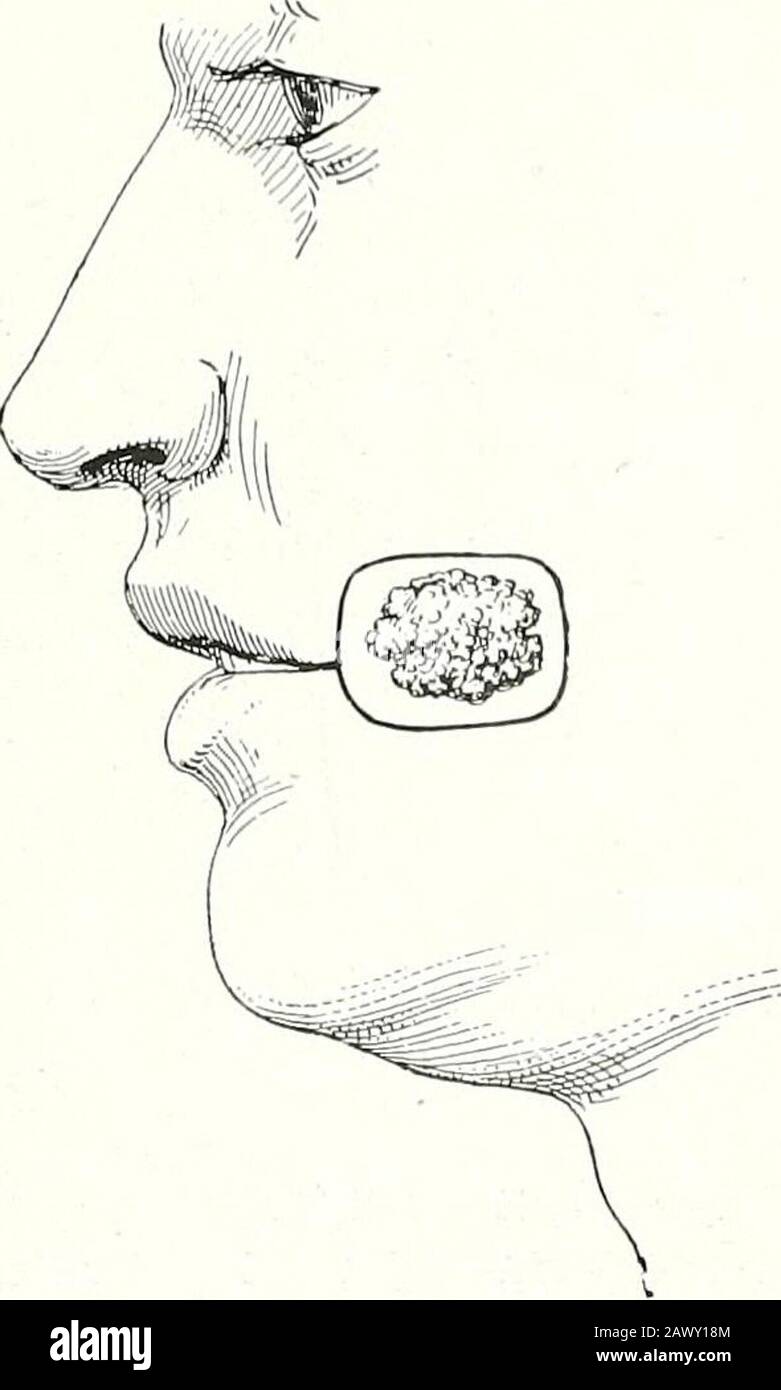 Cutaneous suture hi-res stock photography and images - Alamy