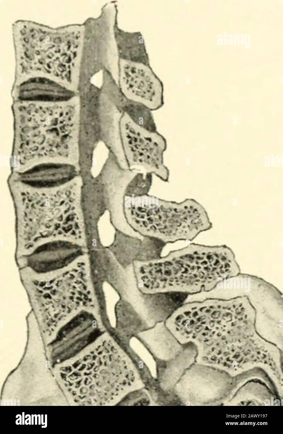 A textbook of obstetrics . Fig. 325.—Spondylolisthesis, well marked ...