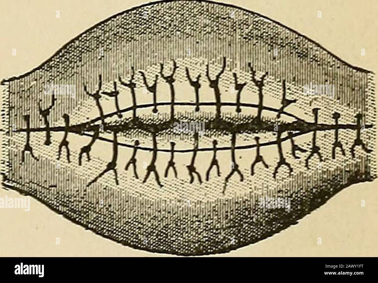 Treatise on gynæcology : medical and surgical . Fig. 122.— Amputation ...