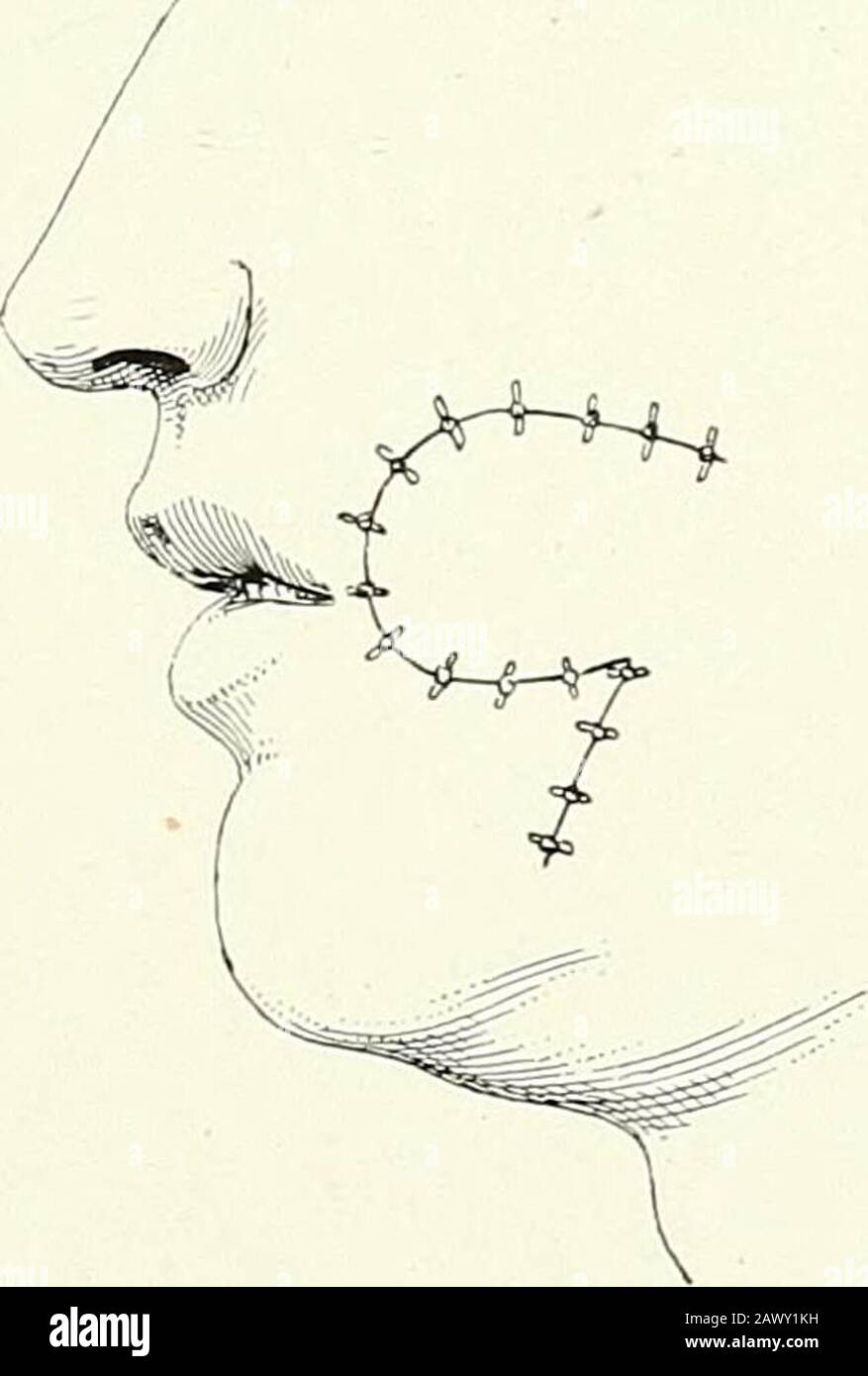 Surgical therapeutics and operative technique . Fig. 87.—SuPERFioiAx ...