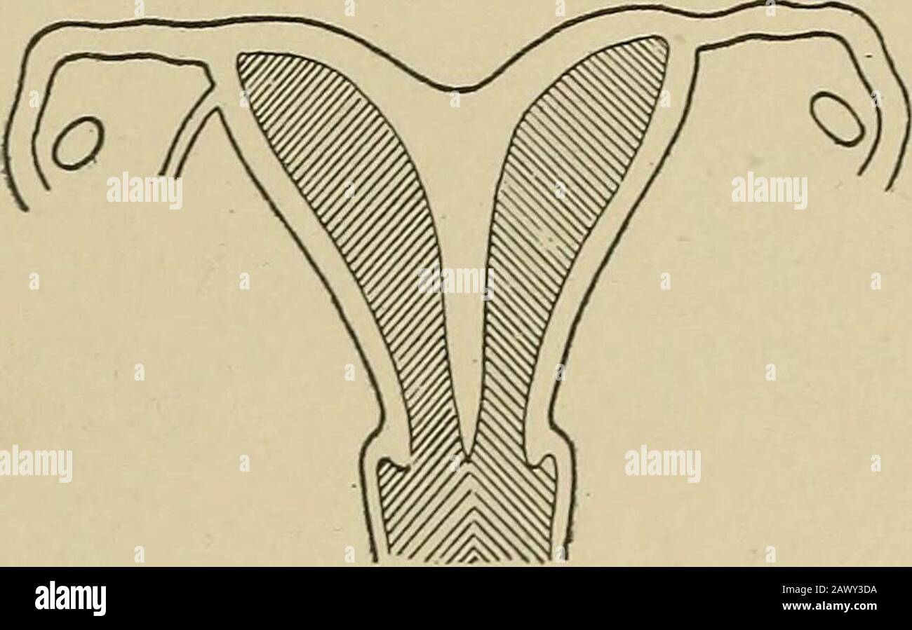Gynecological diagnosis . Fig. 74.—Uterus Bicornis. Fig.. 75.—Uterus ...
