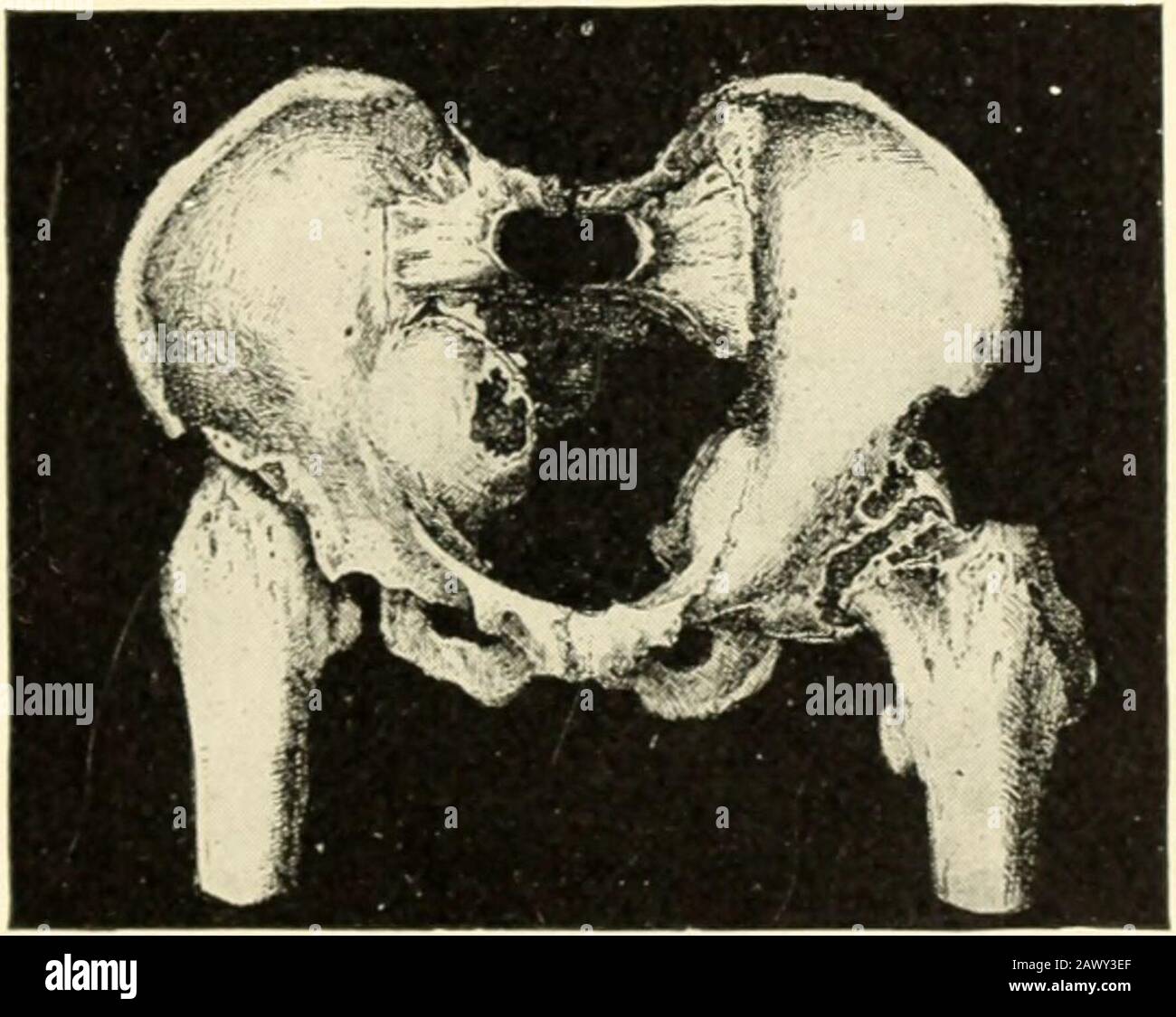 A textbook of obstetrics . Fig. 321.—Fracture of the pelvis (Otto ...