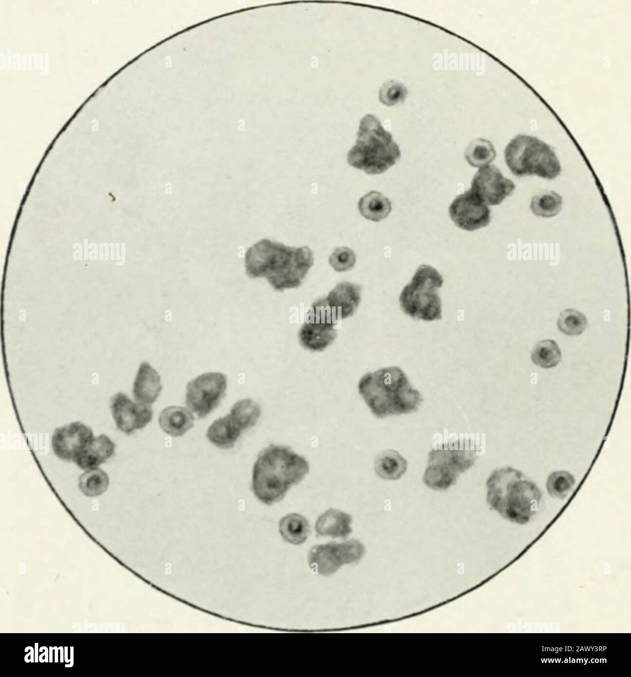 Archives of internal medicine . showed croupous pneumonia ...