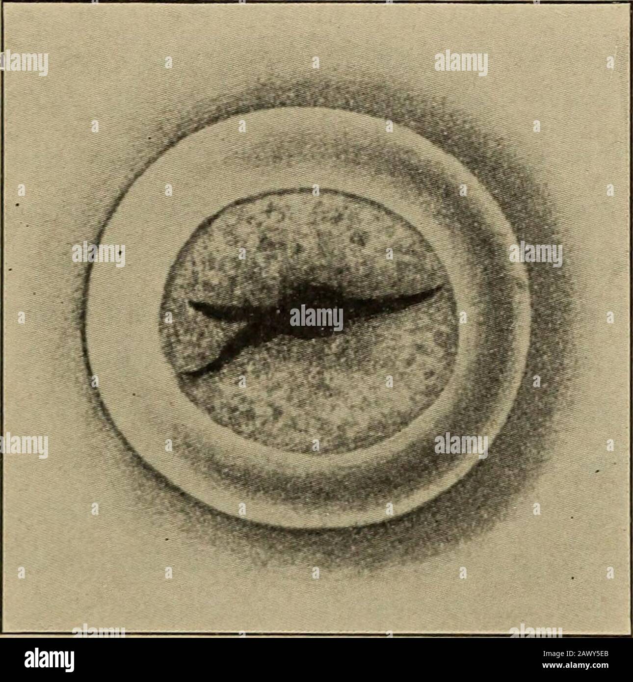 Gynecological diagnosis . i. Having the appearance of ulceration ...