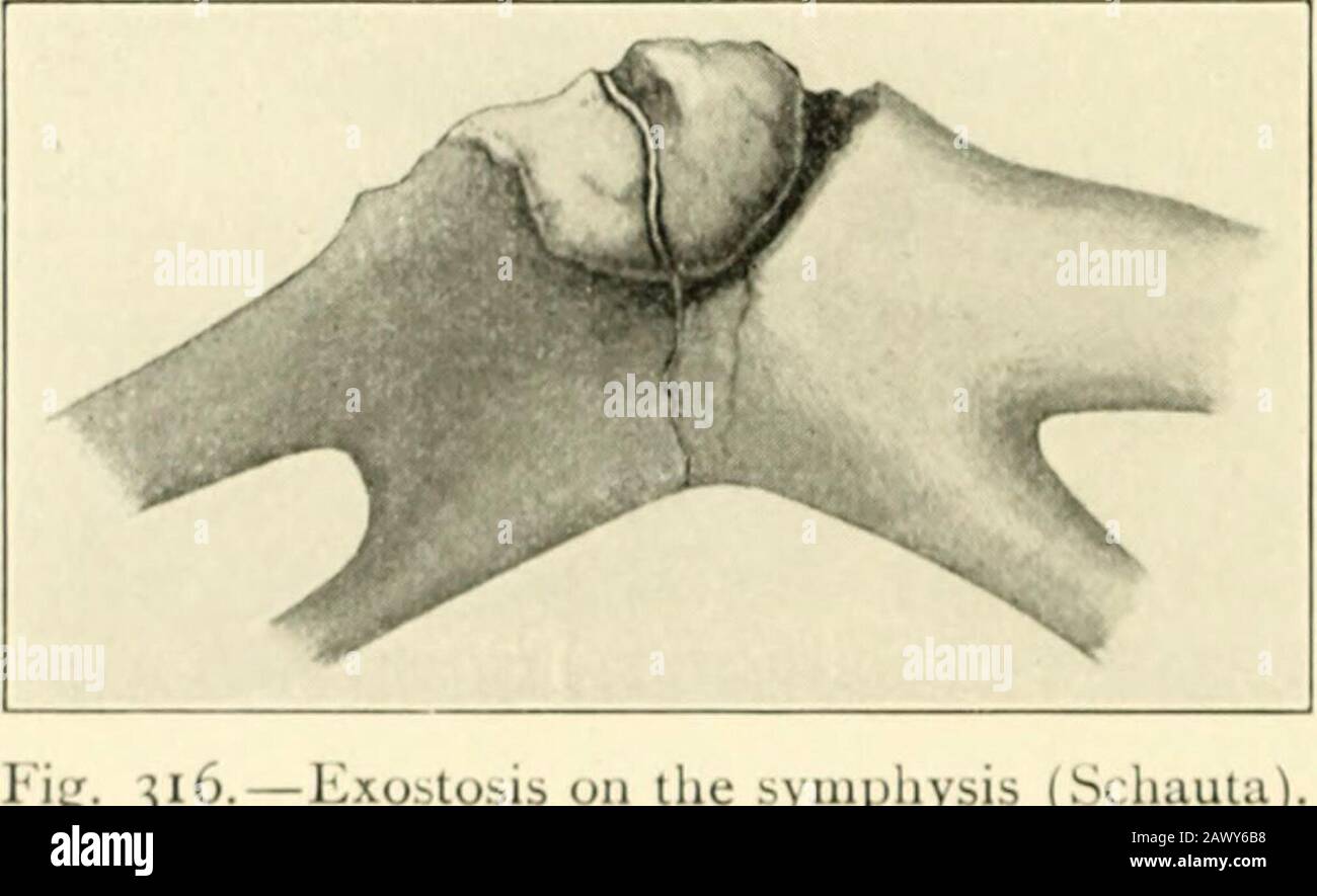 Exostosis pelvis hi-res stock photography and images - Alamy