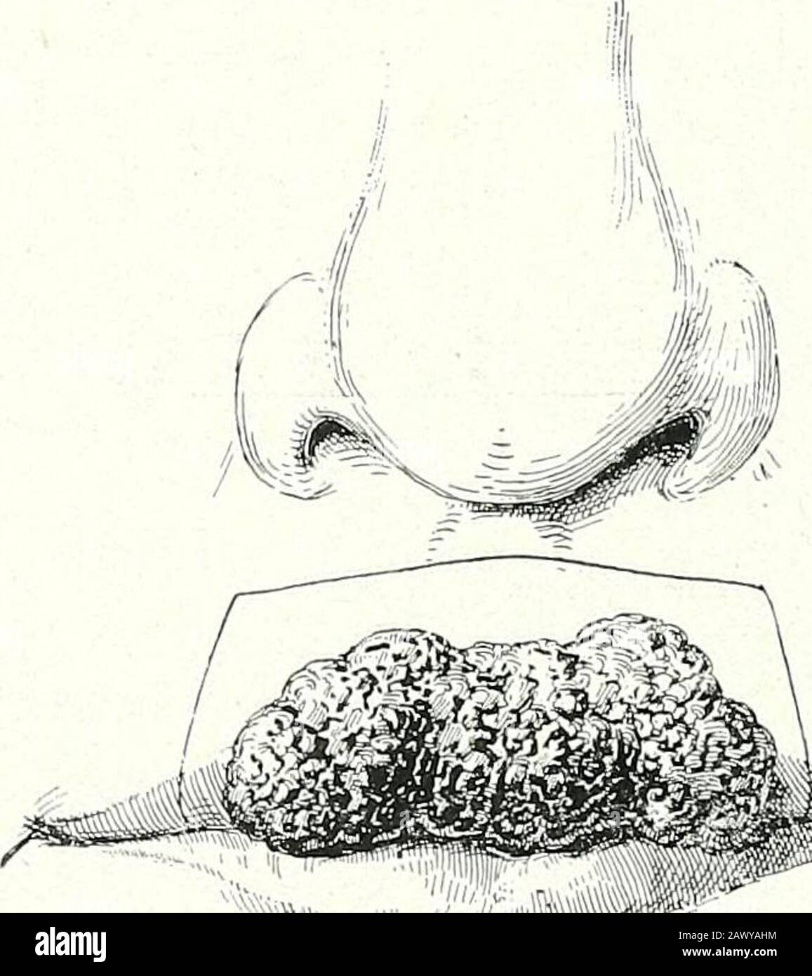 Surgical therapeutics and operative technique . Fig. 72.—Restoration of ...
