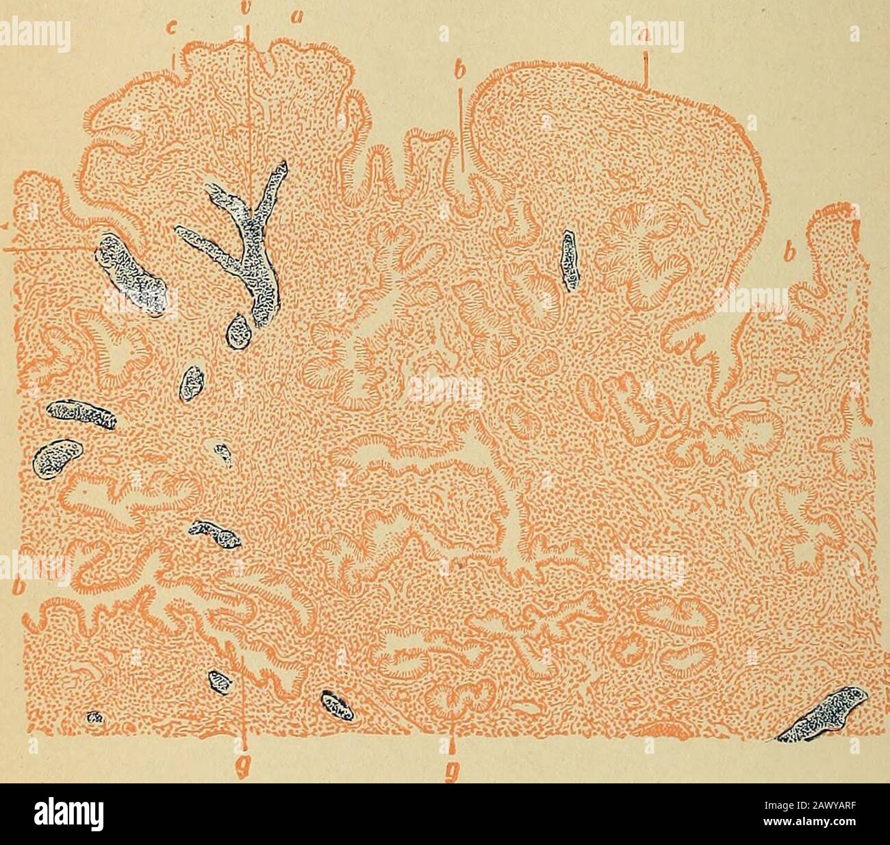 Cystic glandular hi-res stock photography and images - Alamy