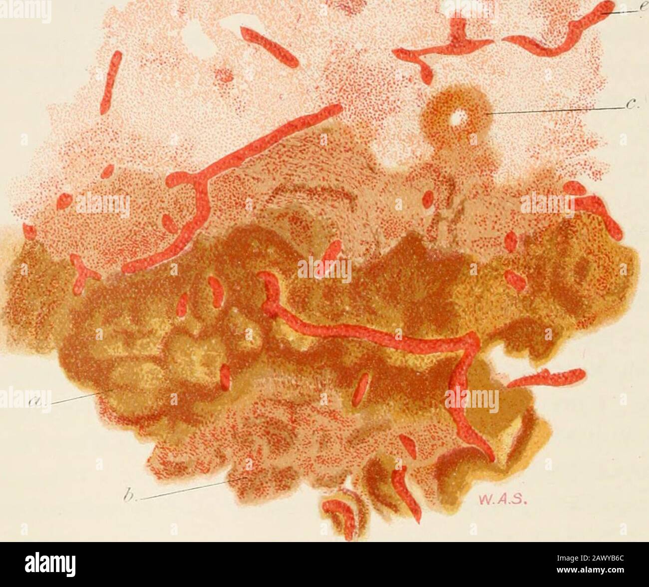 Granulation tissue hi-res stock photography and images - Alamy