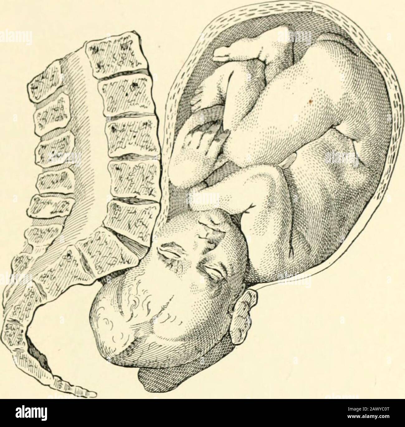 A textbook of obstetrics . I ig. 506.— Rachitic pelvis with double ...