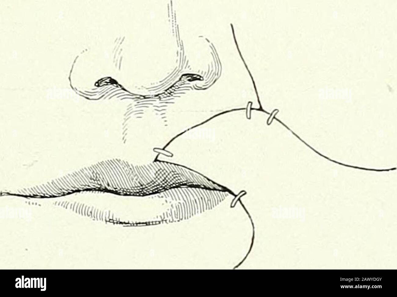 Surgical mapping hi-res stock photography and images - Alamy