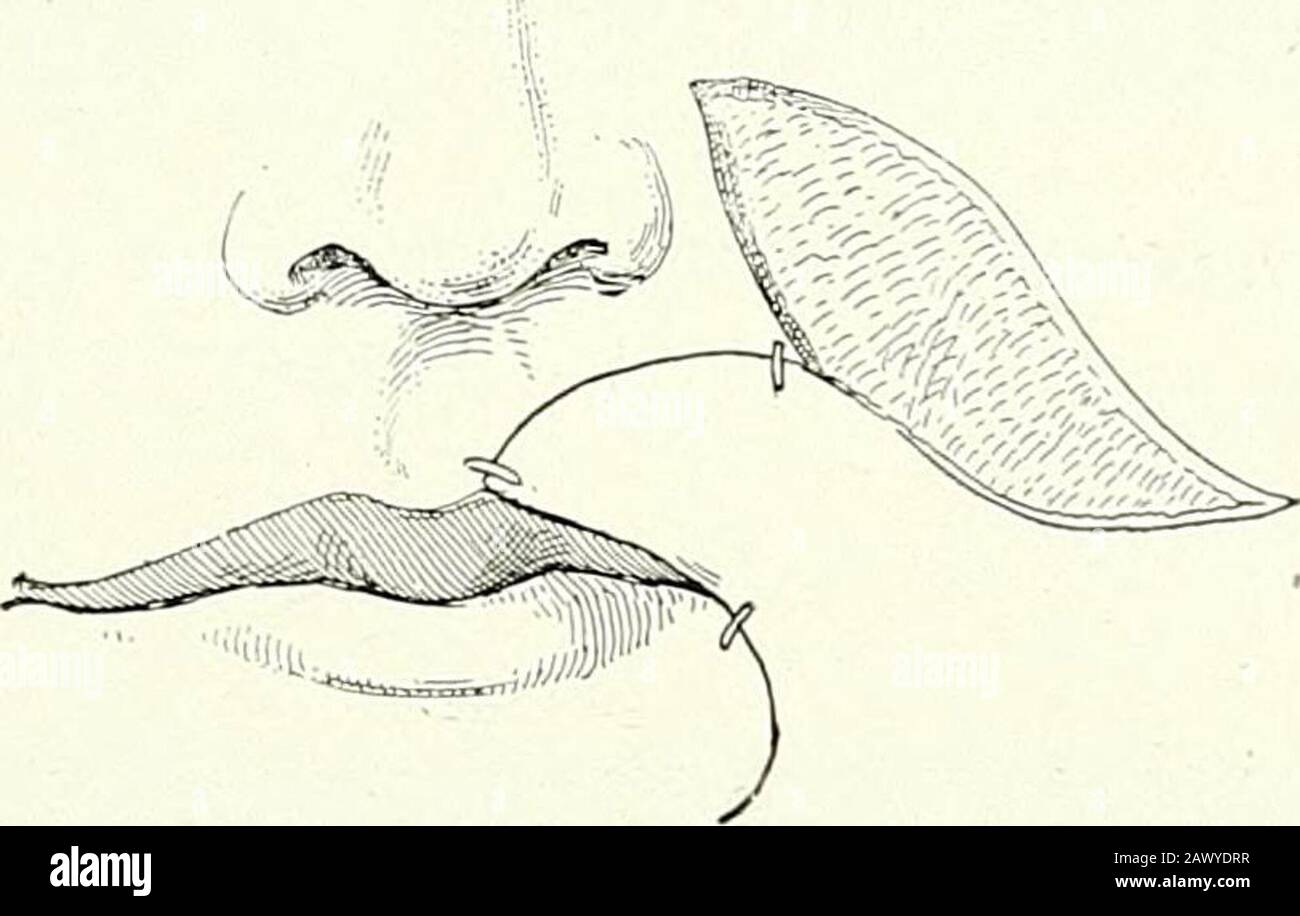 Surgical therapeutics and operative technique . Fig. 65.—Epithelioma of ...