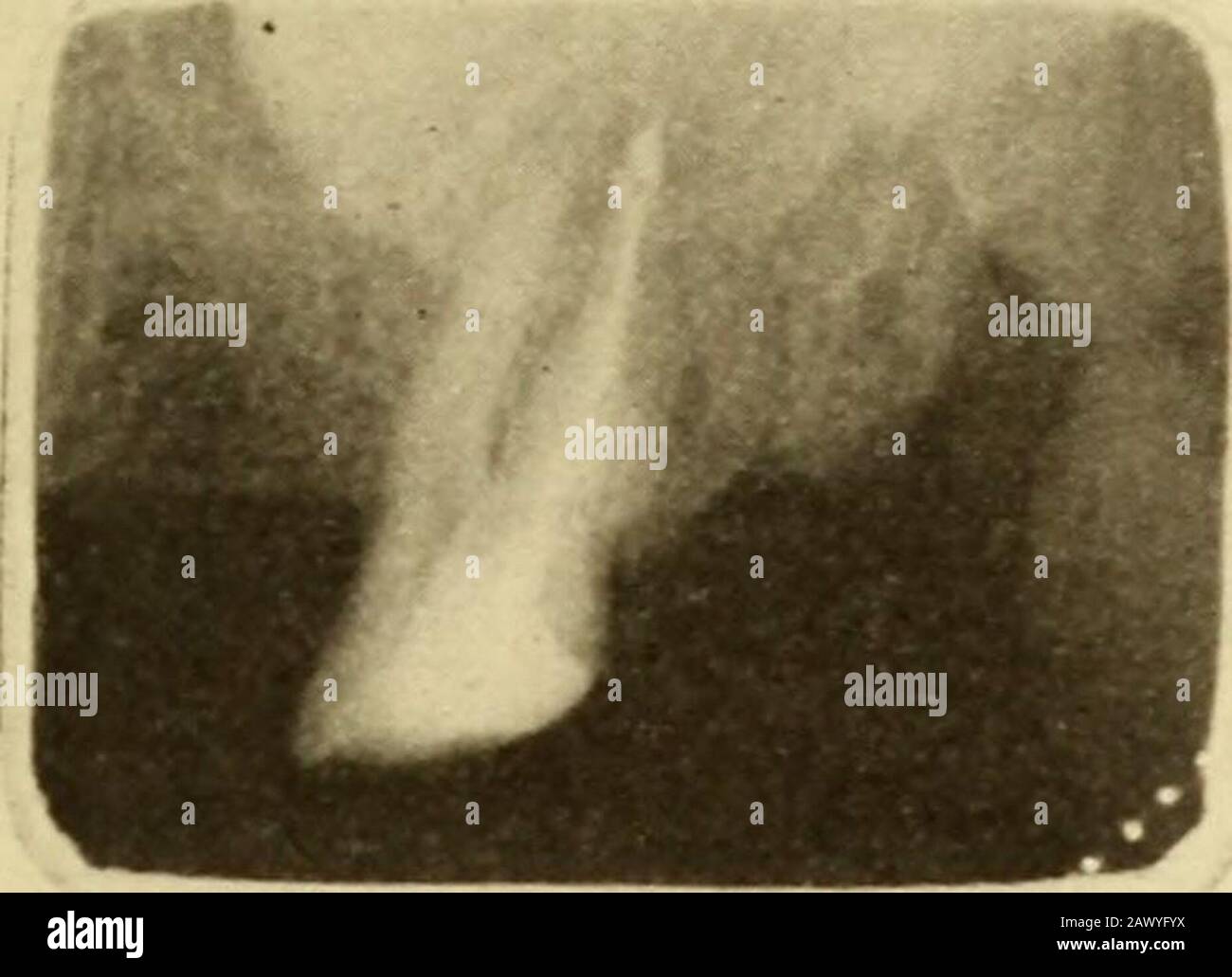 Completely broken teeth hi-res stock photography and images - Alamy