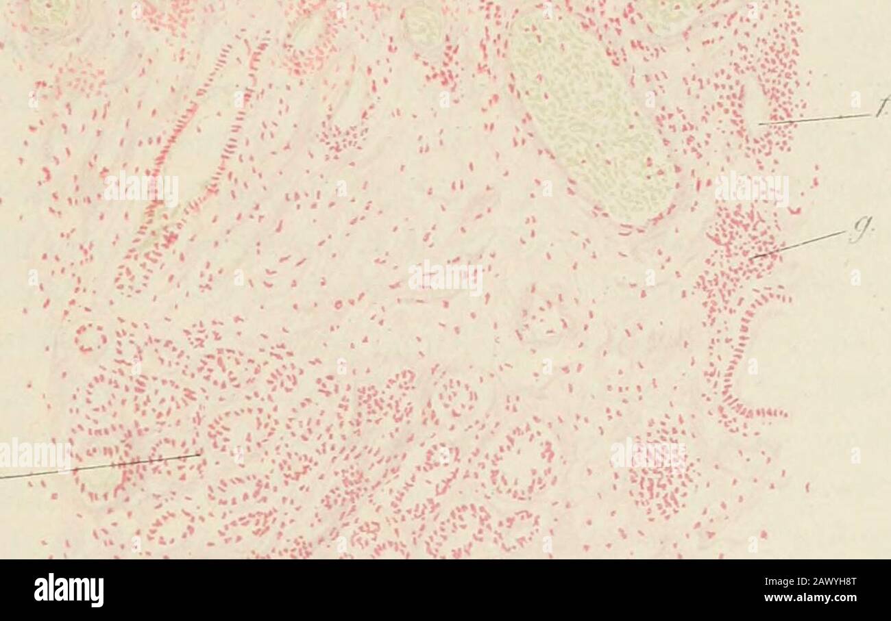 Pharynx diphtheria hi-res stock photography and images - Alamy