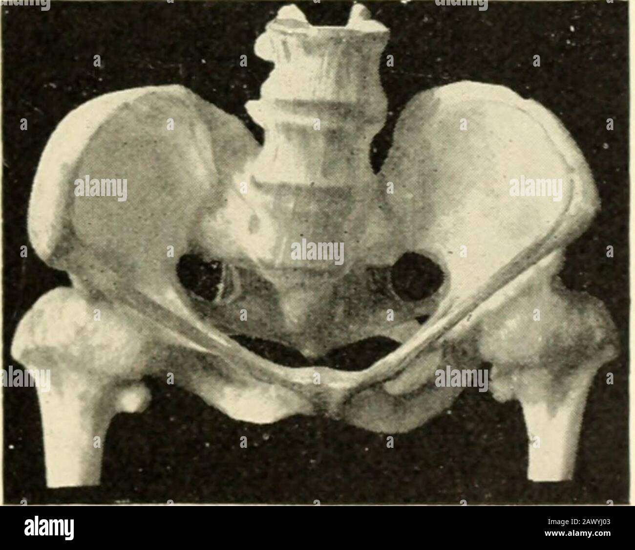 Psoas lordosis hi-res stock photography and images - Alamy