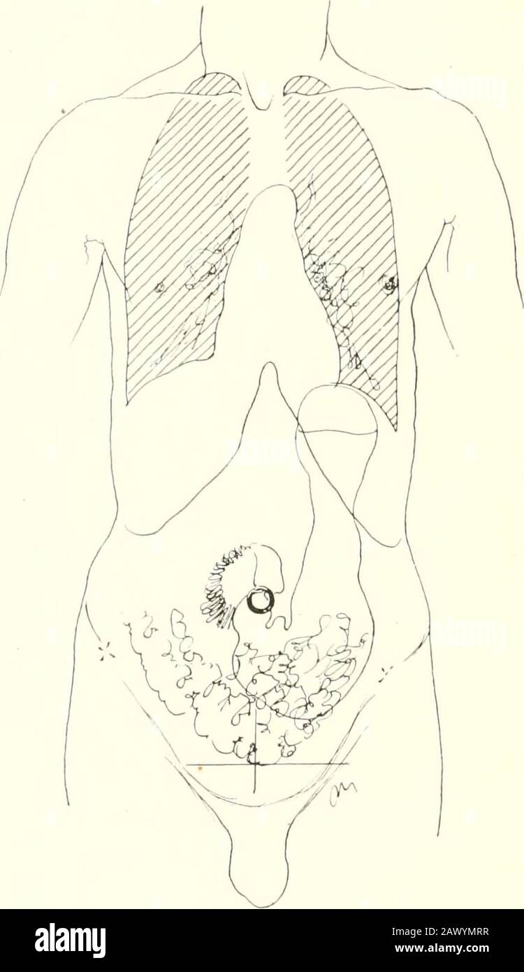 Clinical tuberculosis . Fig. 73.—The hyposthenie to sthenic habitus, a ...