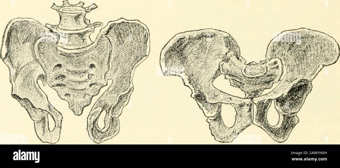 A textbook of obstetrics . bone. The result of this pathological ...