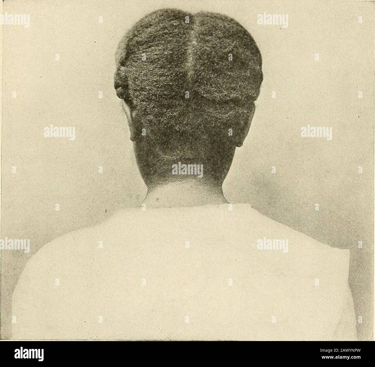 The endemic diseases of the southern states . Fig. 8i.—Back of same ...