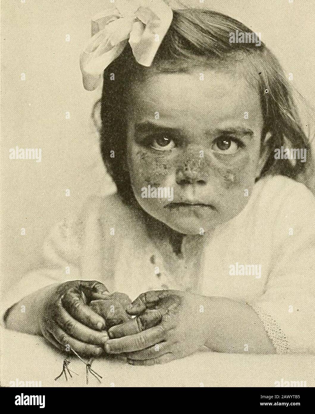 The endemic diseases of the southern states . Fig. 77.—Extensive ...