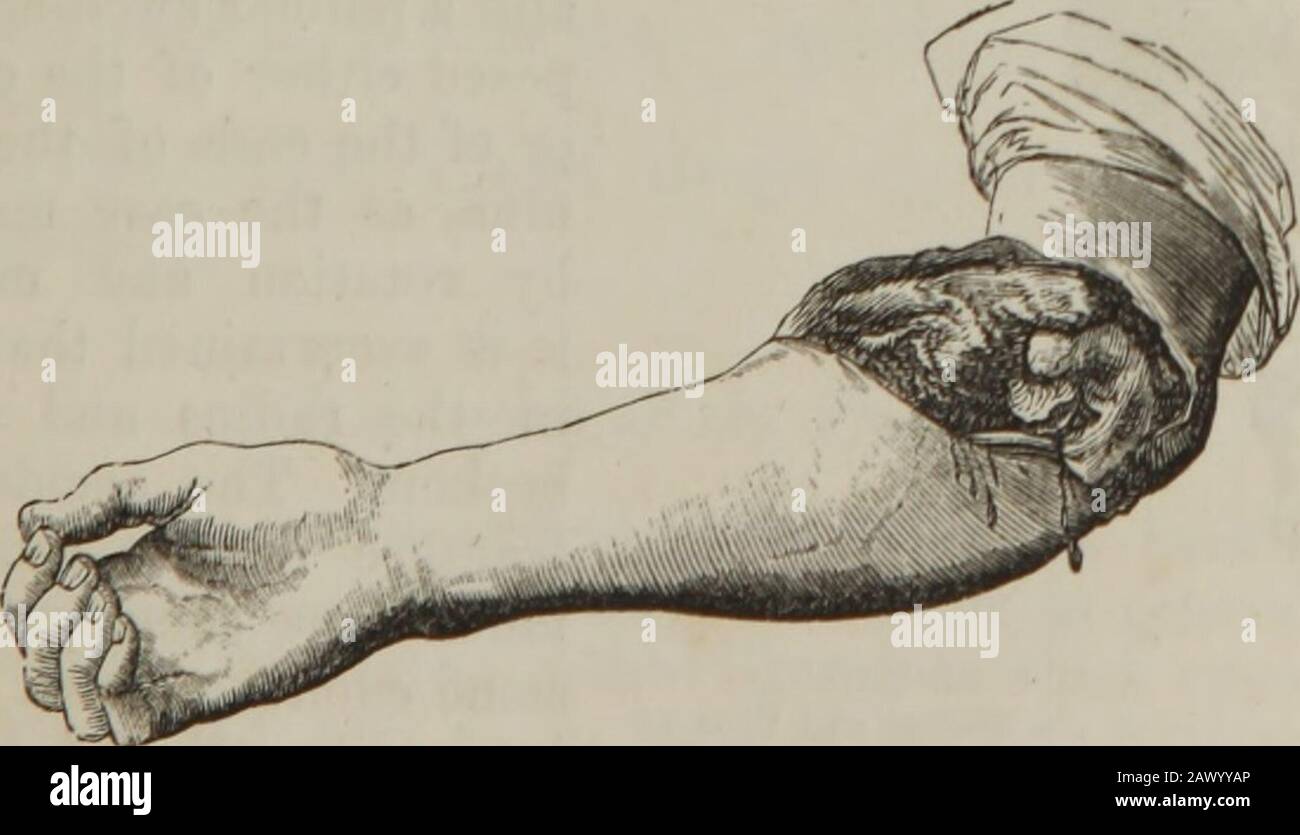 The practice of surgery . Dislocation of the Radius forwards.. Compound ...