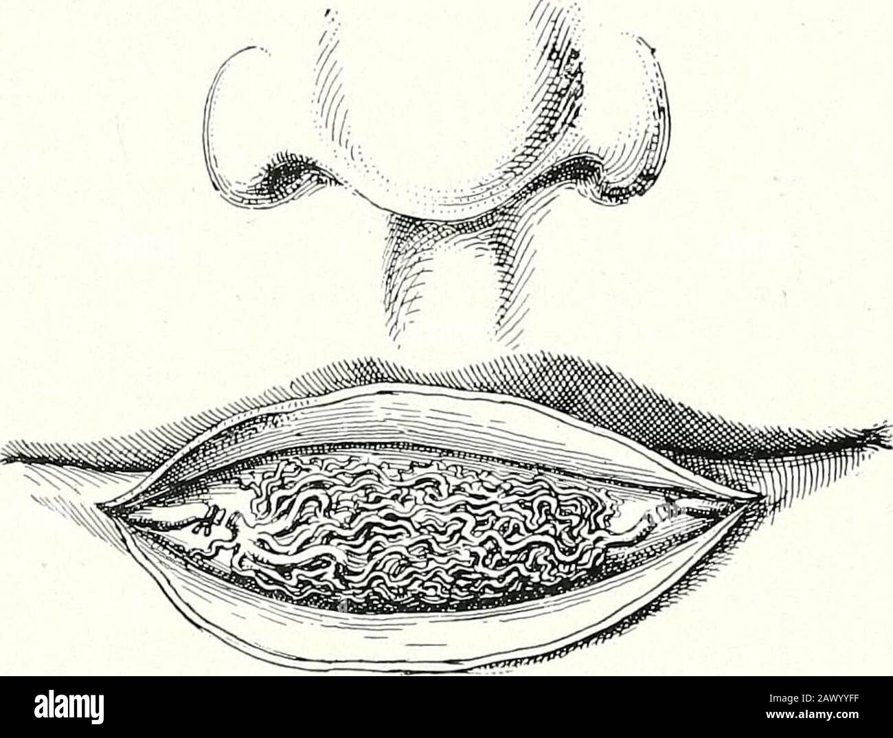 Surgical therapeutics and operative technique . Fig. 44.—Cirsoid ...