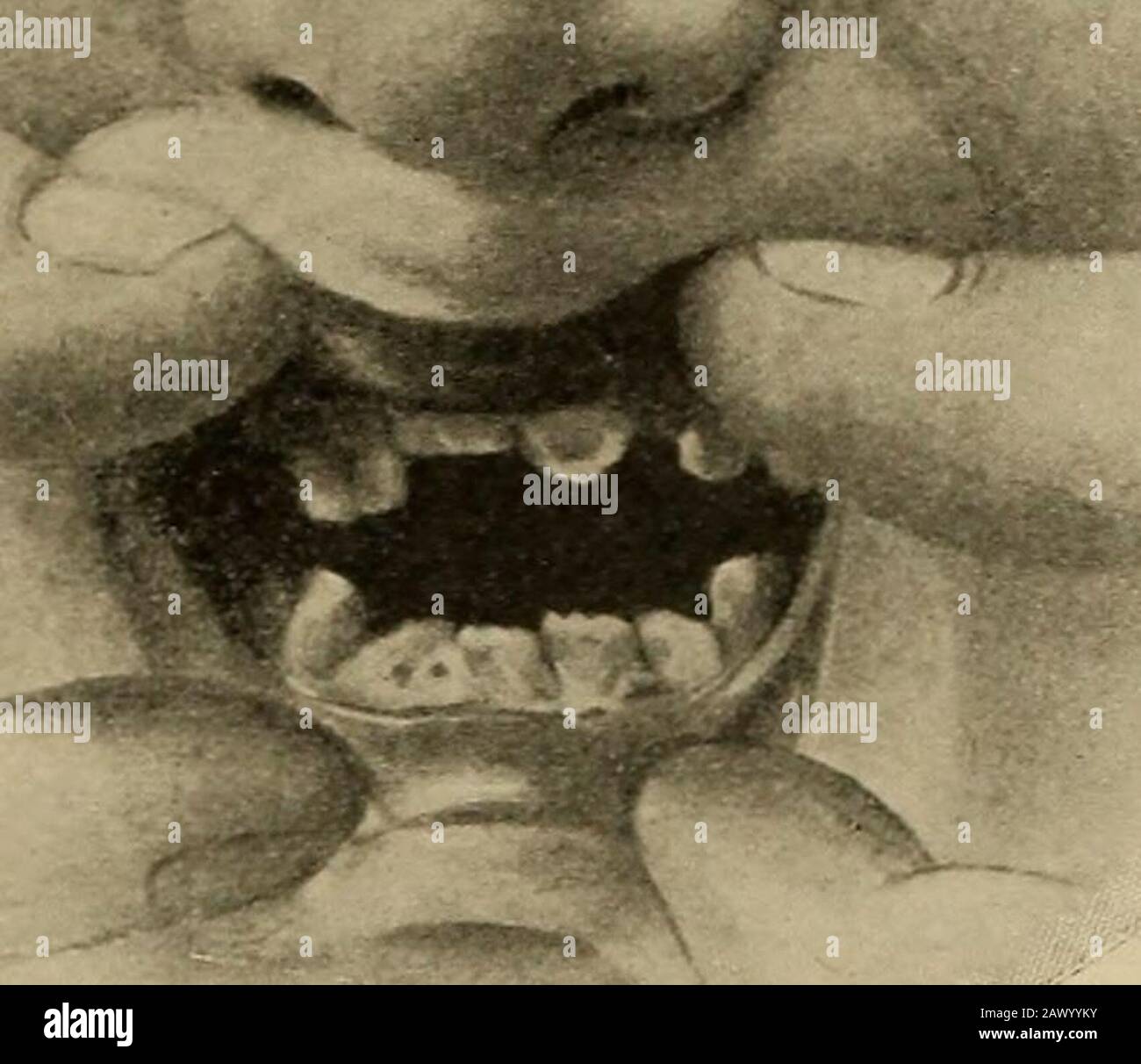 Diseases of children for nurses . Fig. 5.—Rachitic teeth. Boy nine and ...