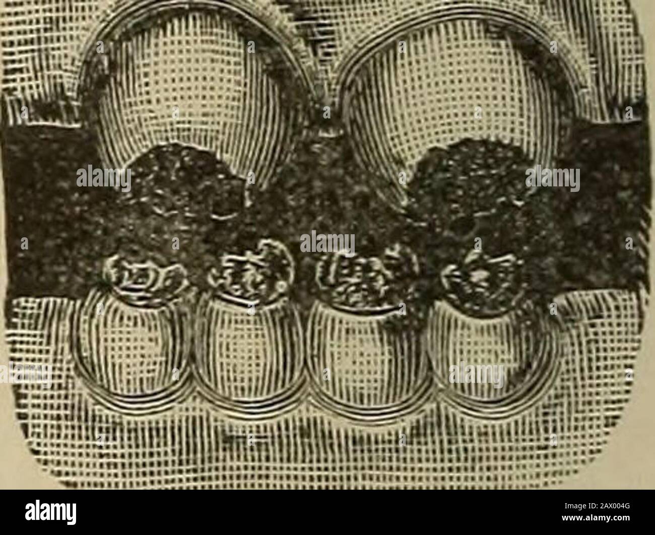 Diseases of children for nurses . Fig. 4.—Hutchinsons teeth in ...