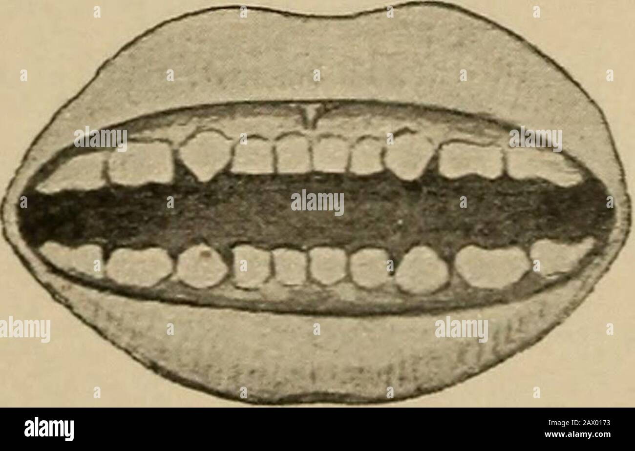 Hutchinsons Teeth Syphilis