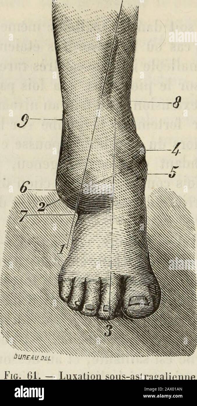 Fracture du pied hi-res stock photography and images - Alamy