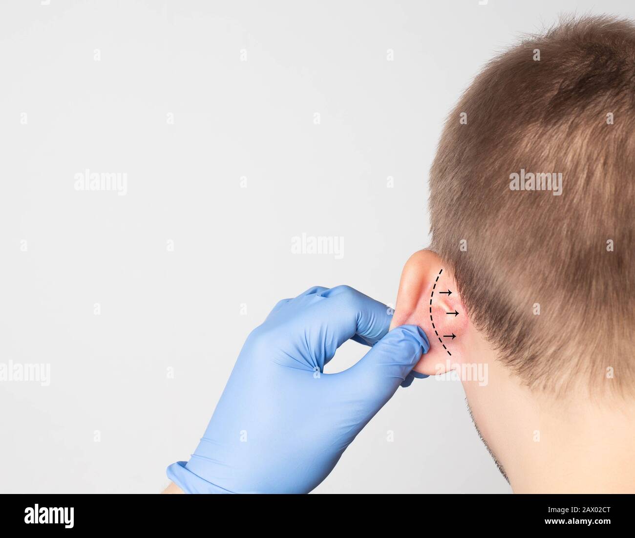 A plastic surgeon doctor examines a male patient s ear for an otoplasty ...