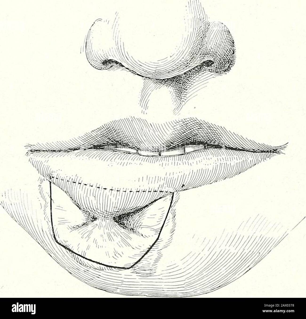 Surgical therapeutics and operative technique . Fig. 37.—Congenital ...