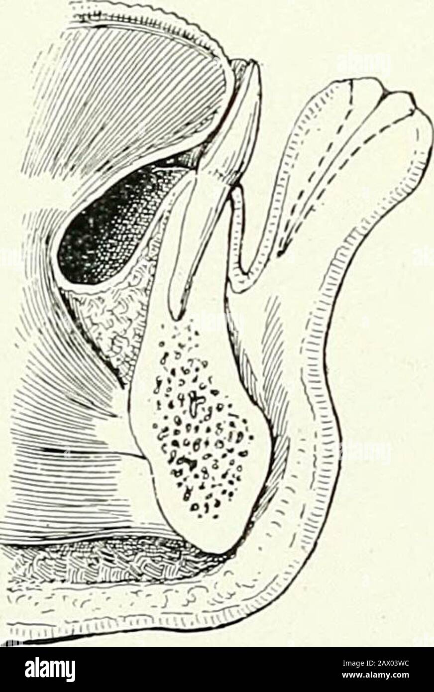 Surgical therapeutics and operative technique . Fig. 35.—Fissure of ...