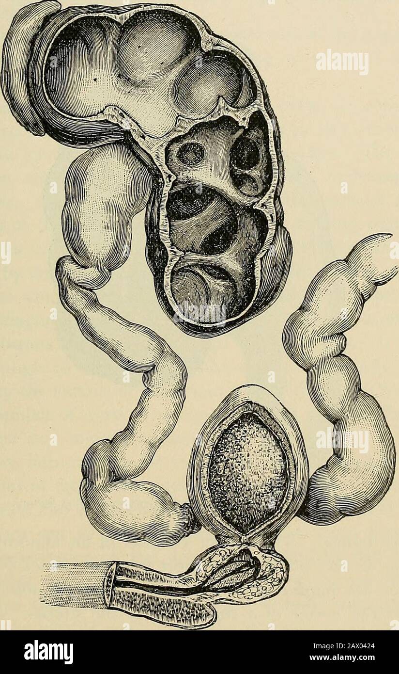 The pathology and surgical treatment of tumors . Fig. 484. -Congenital ...