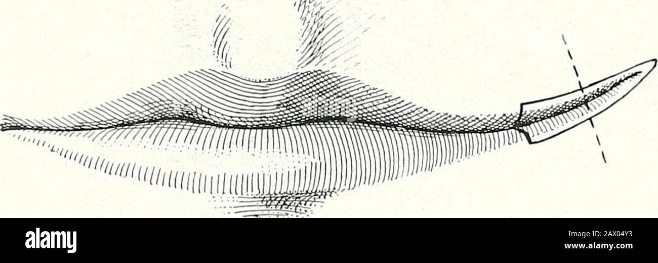 Surgical therapeutics and operative technique . Fig. 32.^—Bilateral ...